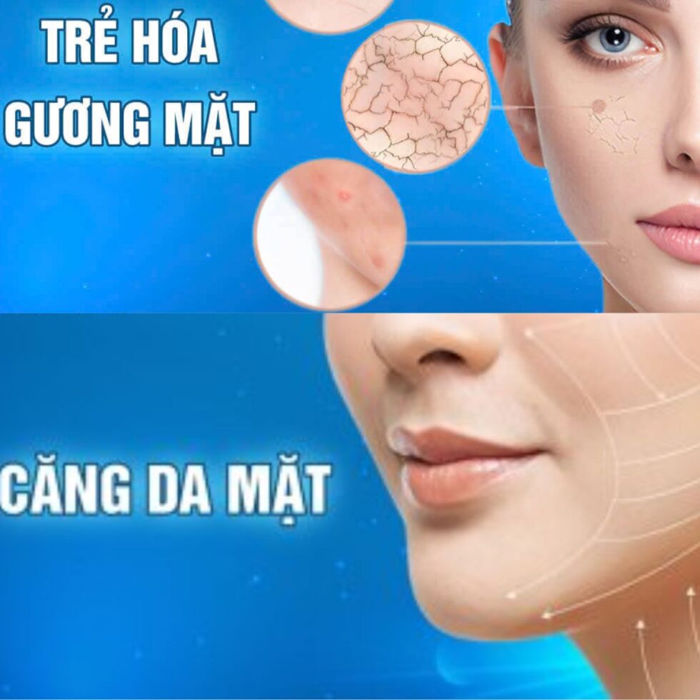 Trẻ hóa gương mặt bằng chỉ collagen có an toàn không? - TMV Nguyễn Du